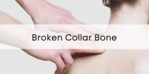 Broken Collar Bone | PhysioRoom Advice