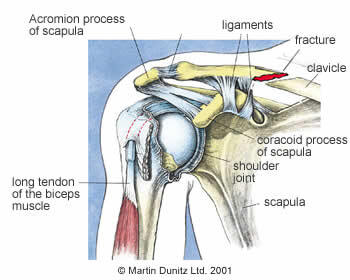 Broken Collar Bone | PhysioRoom Advice